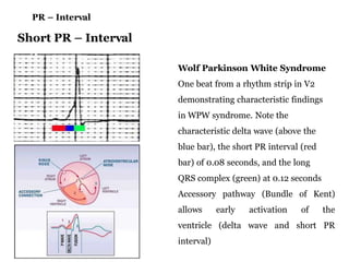 Basic ecg | PPTX