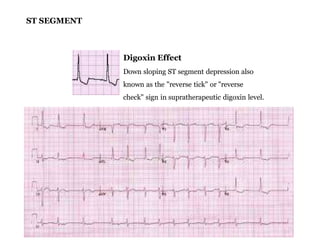Basic ecg | PPTX