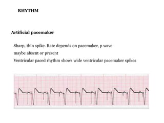 Basic ecg | PPTX