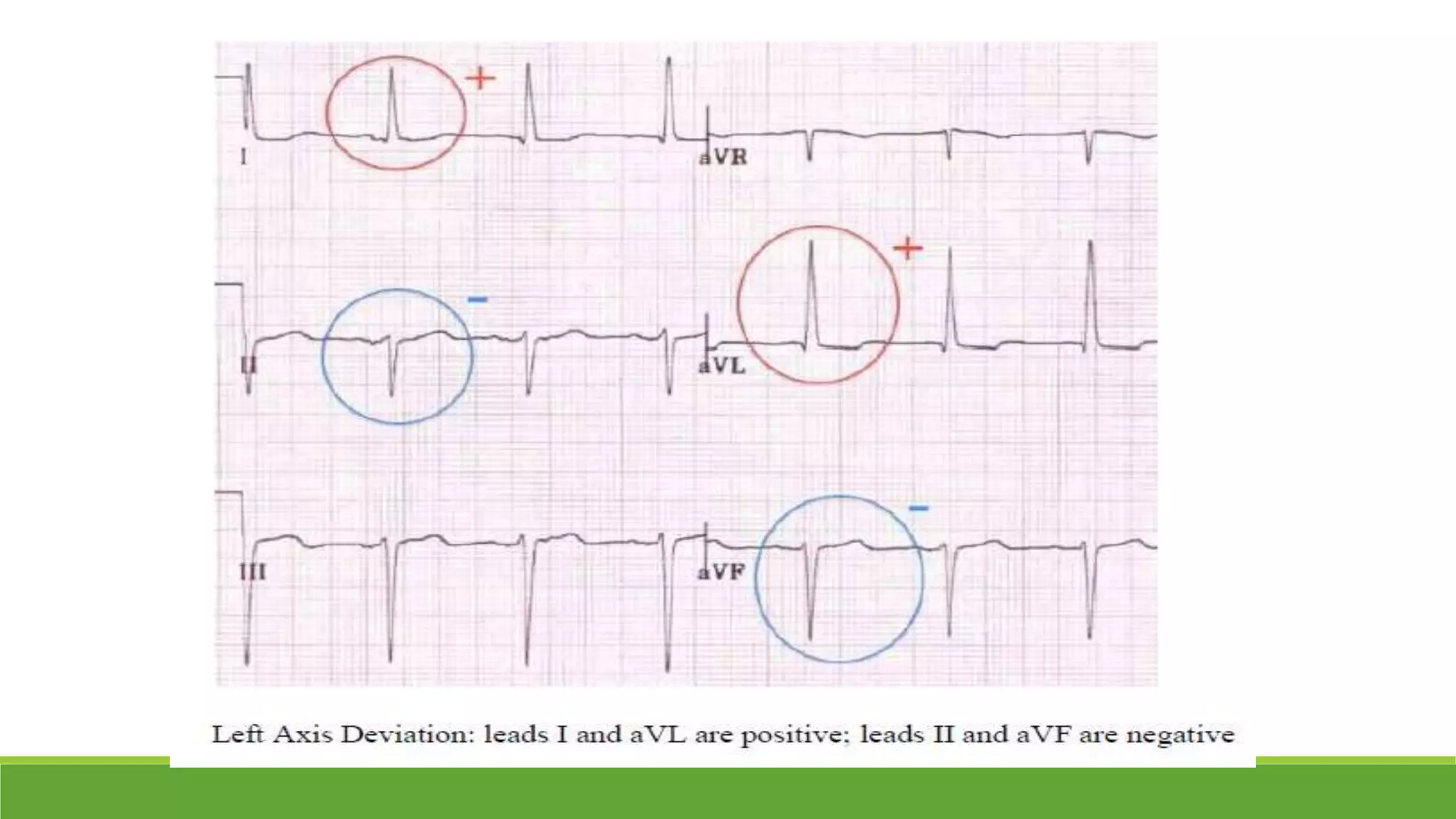 Basic ecg | PPTX