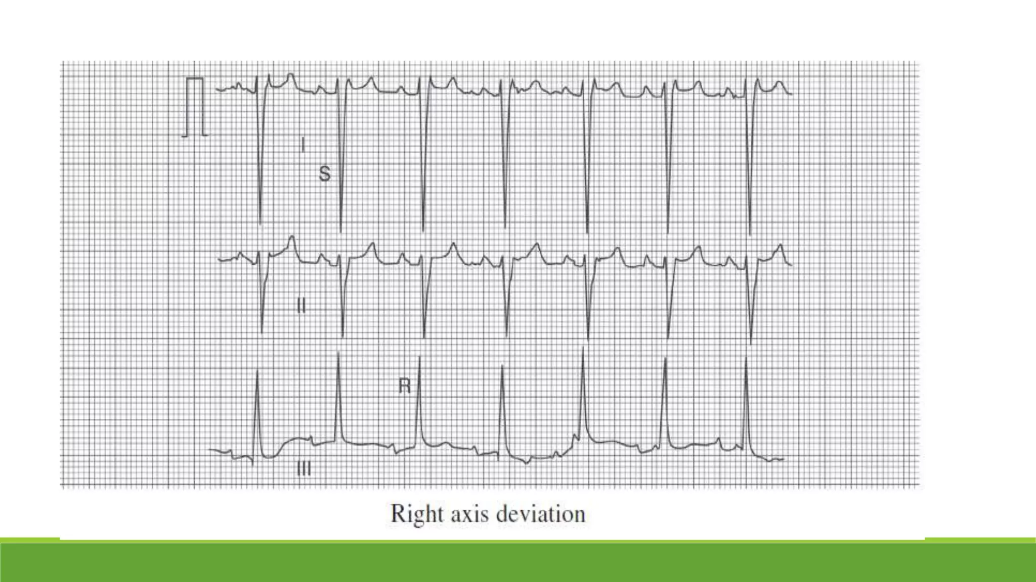 Basic ecg | PPTX