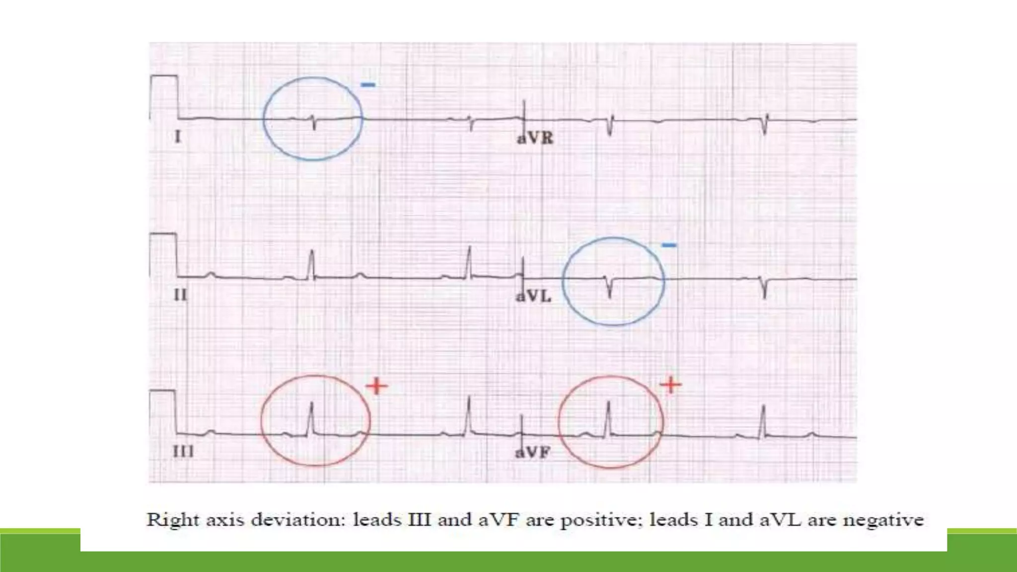 Basic ecg | PPTX