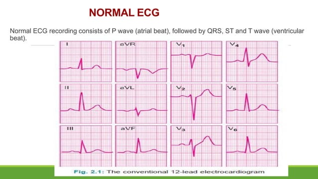 Basic ecg | PPTX