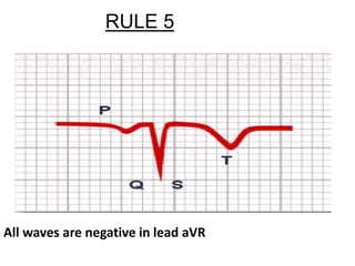 Basic ecg | PPT