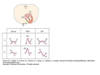 Basic ECG presentation, interval measurement, | PPT
