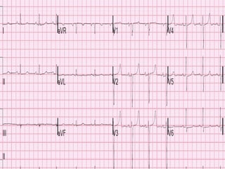 lecture on basic ecg for doctors and nurses | PPT