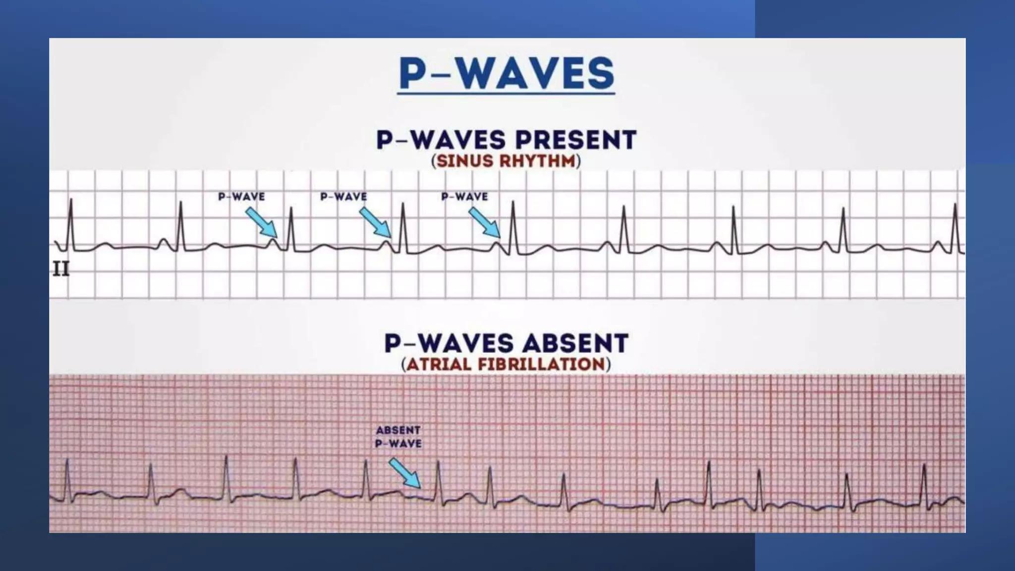 Basic ECG Interpretation.pptx