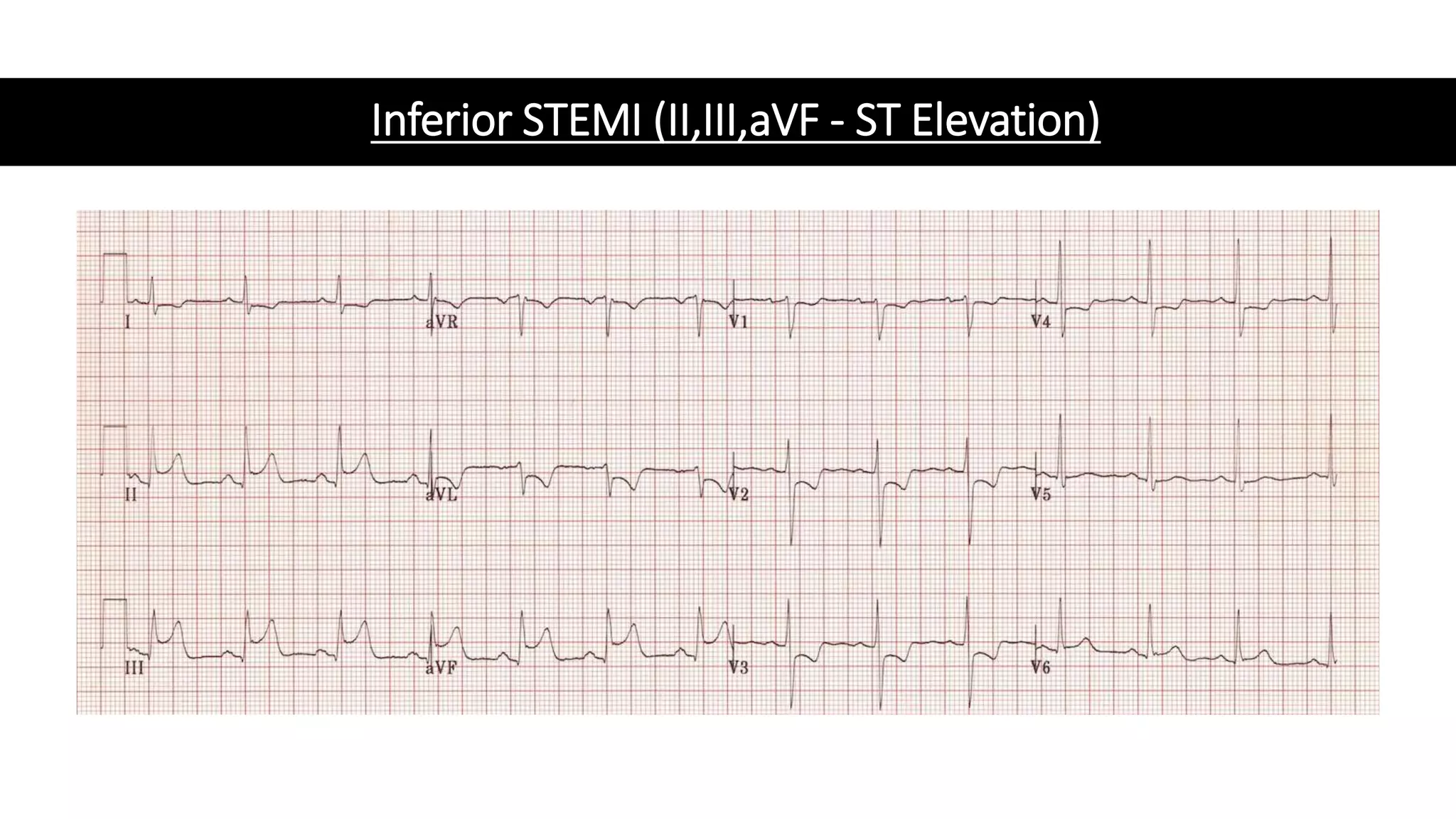 Basic ECG Interpretation.pptx