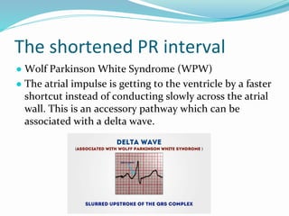 Basic ECG Interpretation for nurses- Leonard.pdf