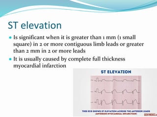 Basic ECG Interpretation for nurses- Leonard.pdf