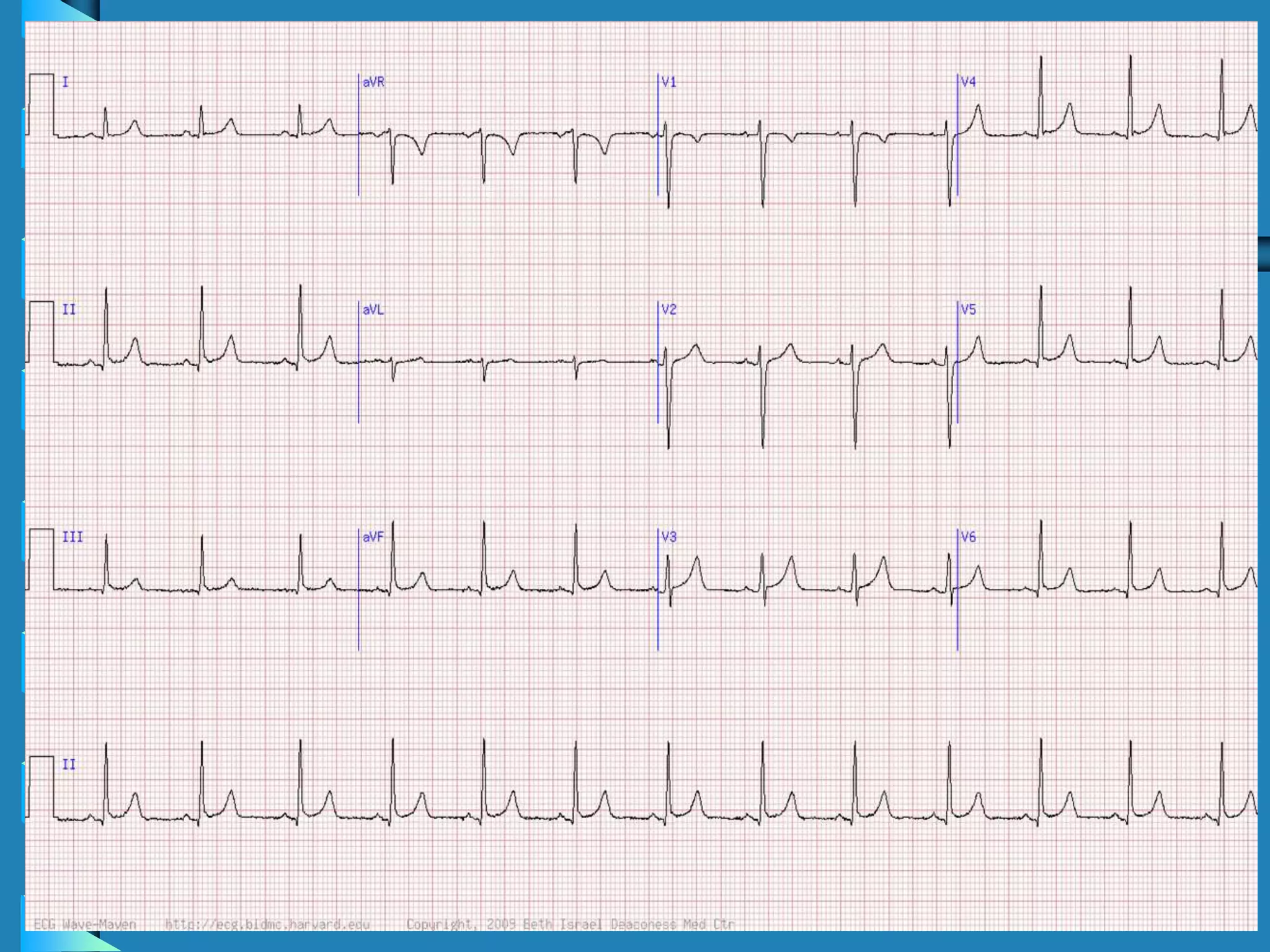 BASIC ECG INTERPRETATION PRESENTATION .ppt | Heart and Cardiovascular ...