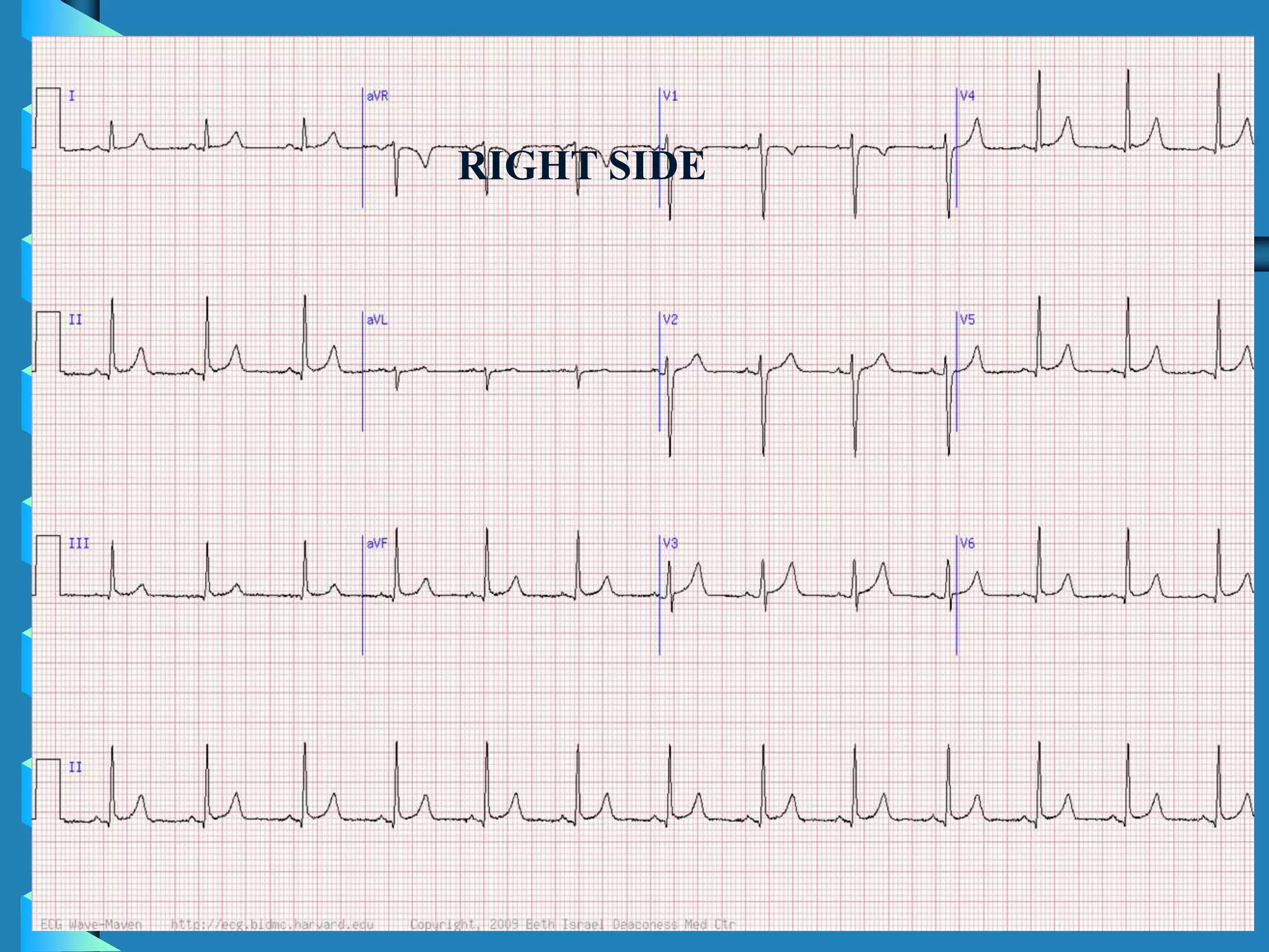BASIC ECG INTERPRETATION PRESENTATION .ppt