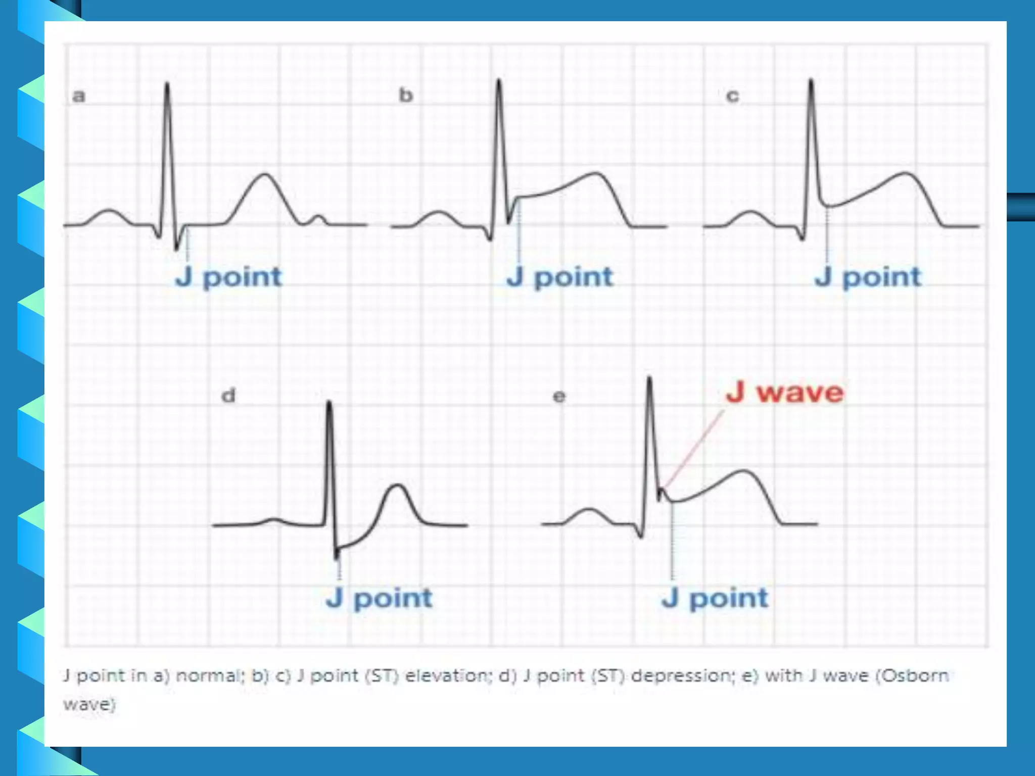 BASIC ECG INTERPRETATION PRESENTATION .ppt