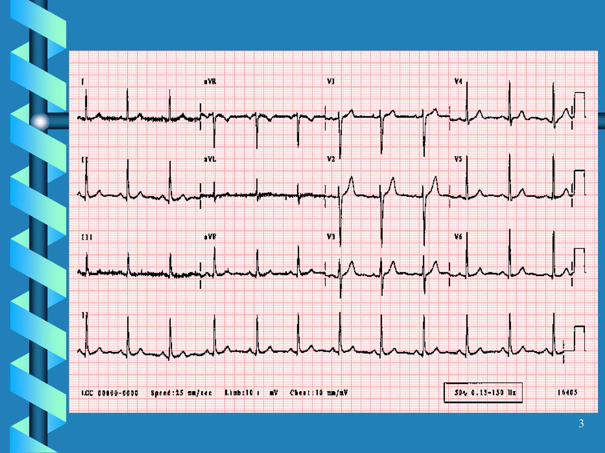BASIC ECG INTERPRETATION PRESENTATION .ppt | Heart and Cardiovascular ...