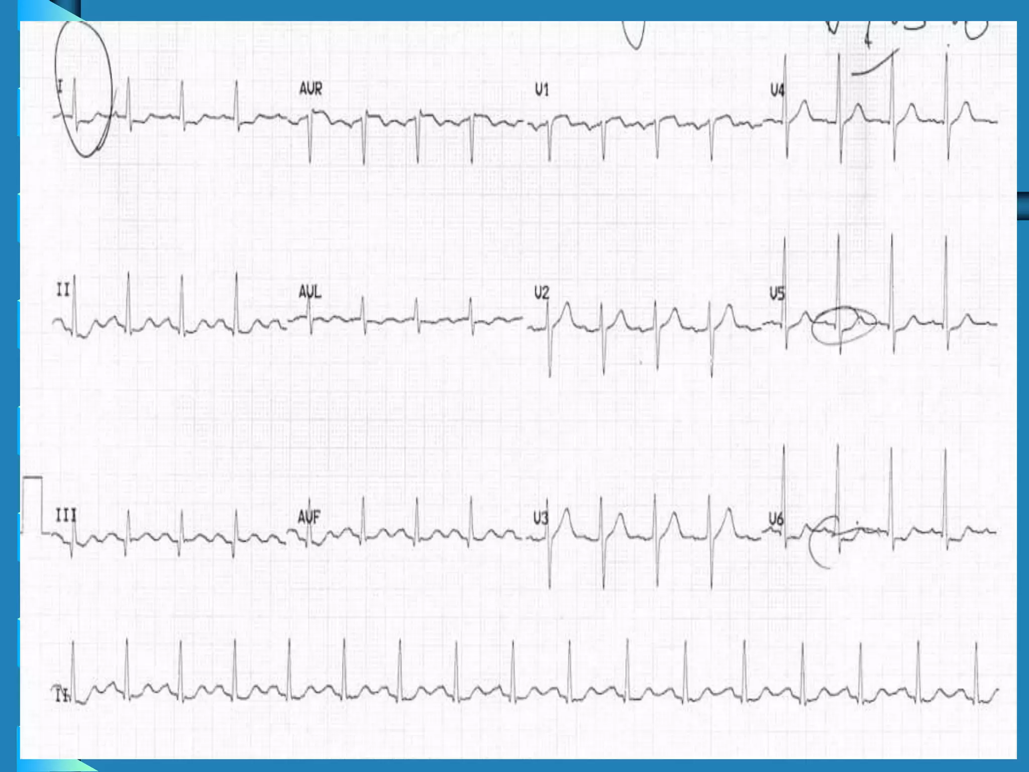 BASIC ECG INTERPRETATION PRESENTATION .ppt