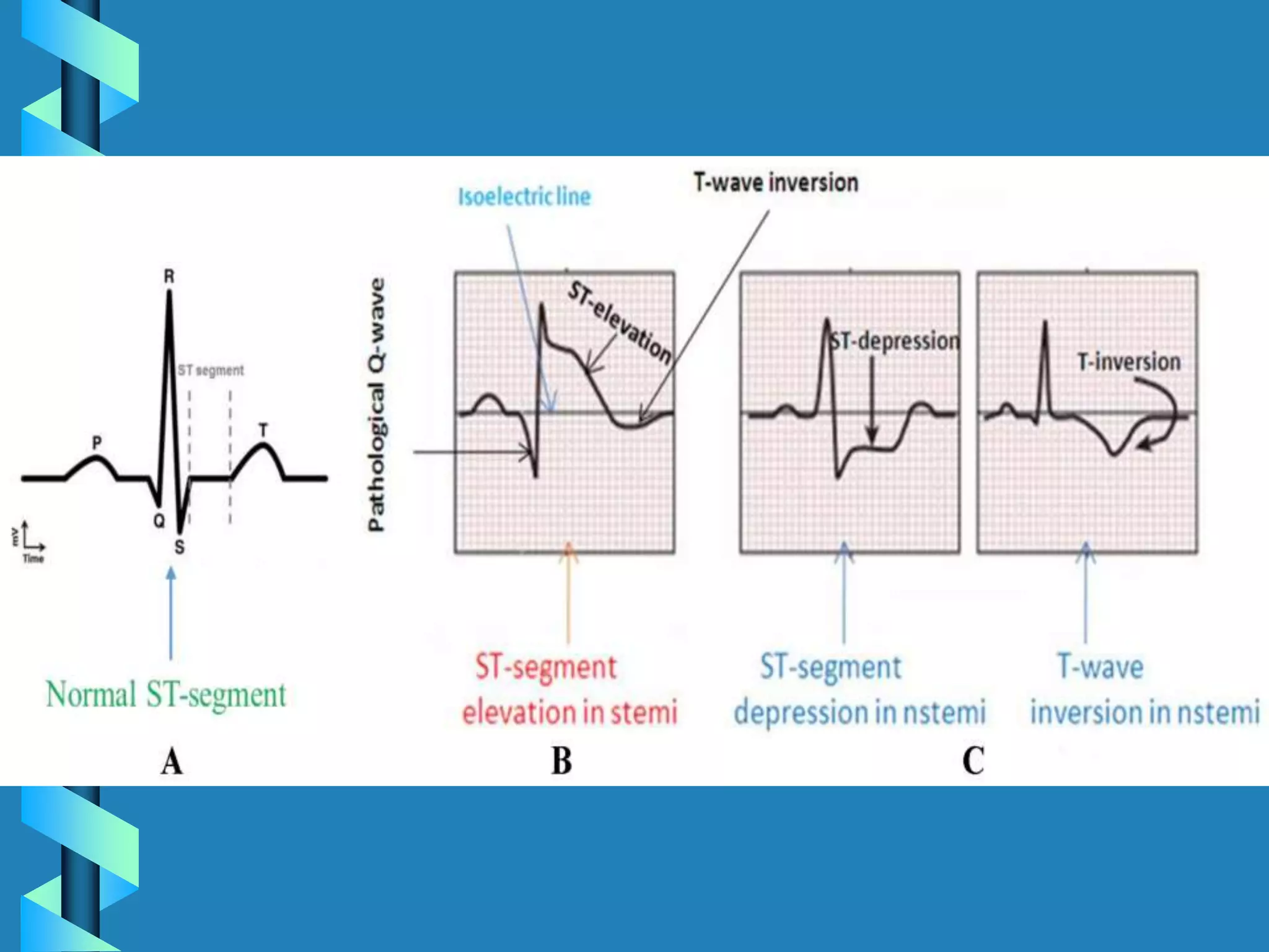 BASIC ECG INTERPRETATION PRESENTATION .ppt