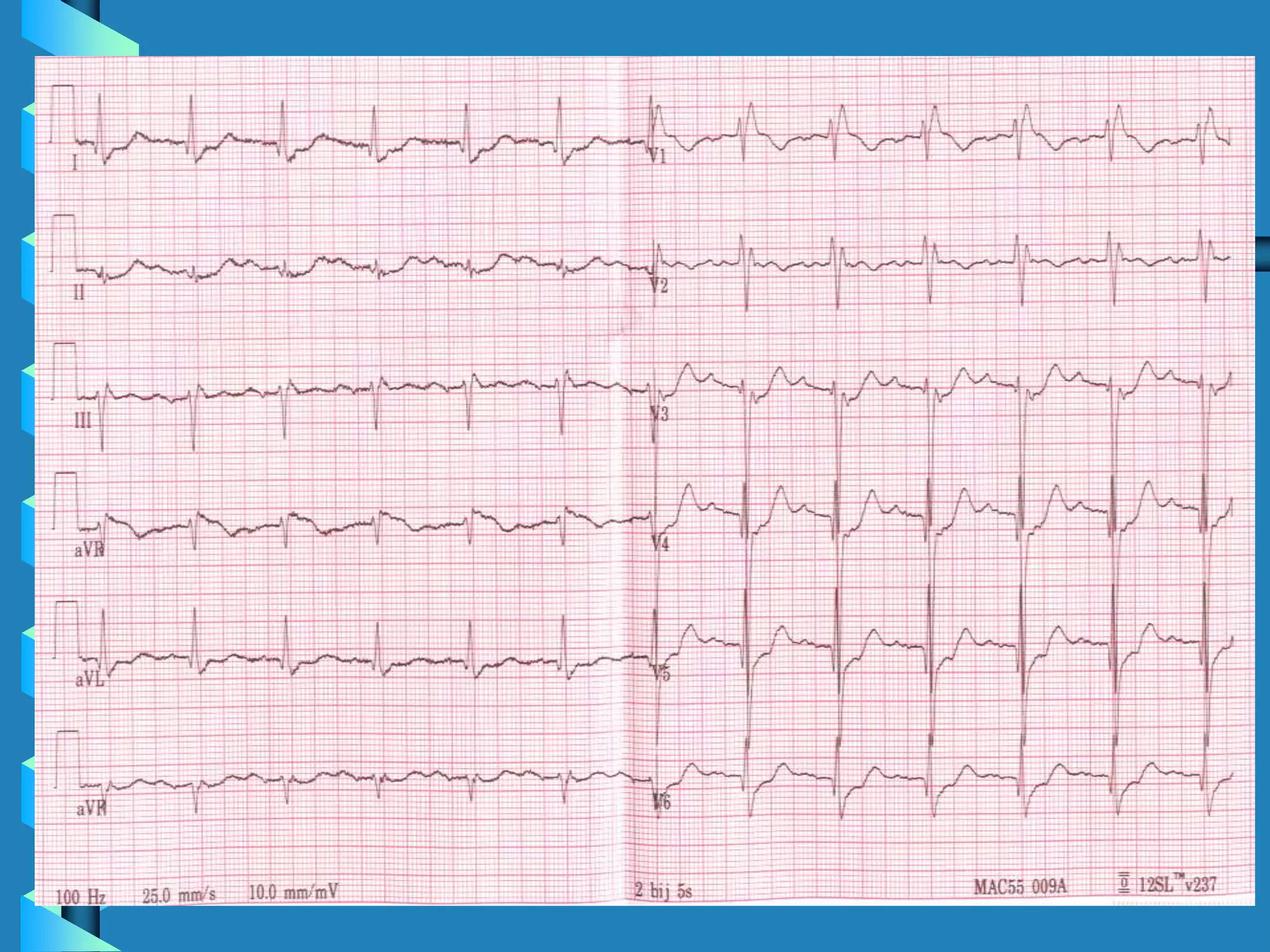 BASIC ECG INTERPRETATION PRESENTATION .ppt