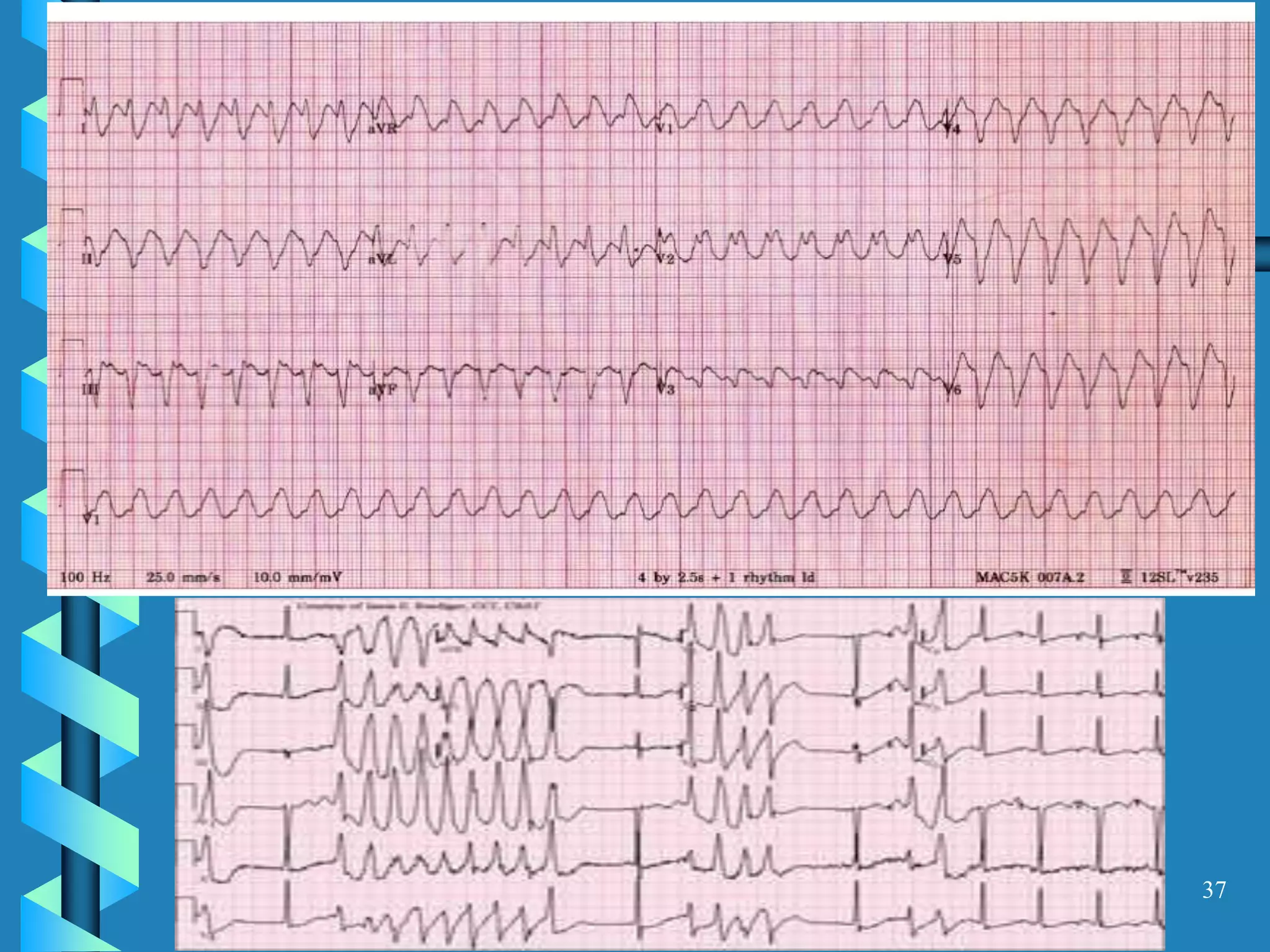 BASIC ECG INTERPRETATION PRESENTATION .ppt | Heart and Cardiovascular ...