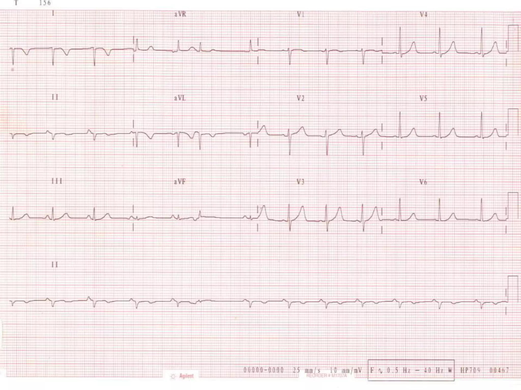 BASIC ECG INTERPRETATION PRESENTATION .ppt