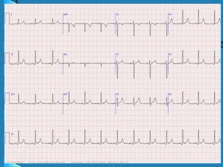 BASIC ECG INTERPRETATION PRESENTATION .ppt | Heart and Cardiovascular Diseases | Diseases and ...