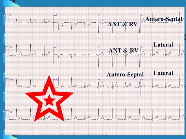 BASIC ECG INTERPRETATION PRESENTATION .ppt | Heart and Cardiovascular Diseases | Diseases and ...