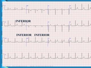 BASIC ECG INTERPRETATION PRESENTATION .ppt | Heart and Cardiovascular ...