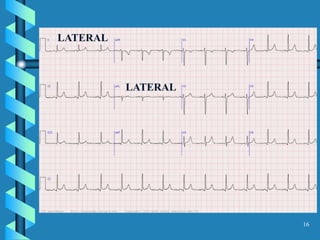 BASIC ECG INTERPRETATION PRESENTATION .ppt | Heart and Cardiovascular ...