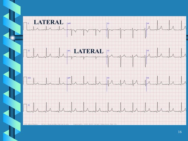 BASIC ECG INTERPRETATION PRESENTATION .ppt | Heart and Cardiovascular Diseases | Diseases and ...
