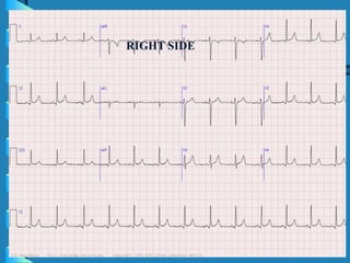 BASIC ECG INTERPRETATION PRESENTATION .ppt | Heart and Cardiovascular ...