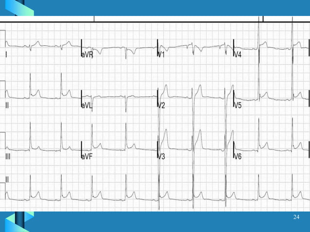 BASIC ECG INTERPRETATION PRESENTATION .ppt | Heart and Cardiovascular Diseases | Diseases and ...