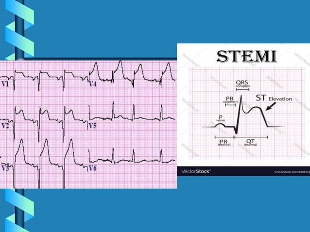 BASIC ECG INTERPRETATION PRESENTATION .ppt | Heart and Cardiovascular Diseases | Diseases and ...