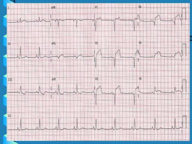 BASIC ECG INTERPRETATION PRESENTATION .ppt | Heart and Cardiovascular Diseases | Diseases and ...