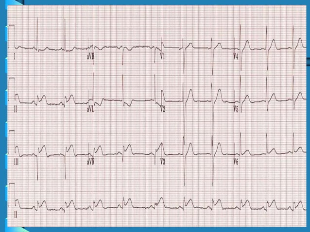 BASIC ECG INTERPRETATION PRESENTATION .ppt | Heart and Cardiovascular ...