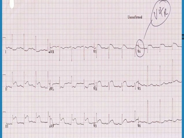 BASIC ECG INTERPRETATION PRESENTATION .ppt | Heart and Cardiovascular Diseases | Diseases and ...