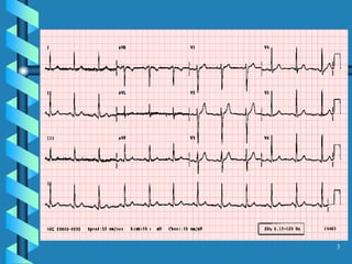 BASIC ECG INTERPRETATION PRESENTATION .ppt | Heart and Cardiovascular ...