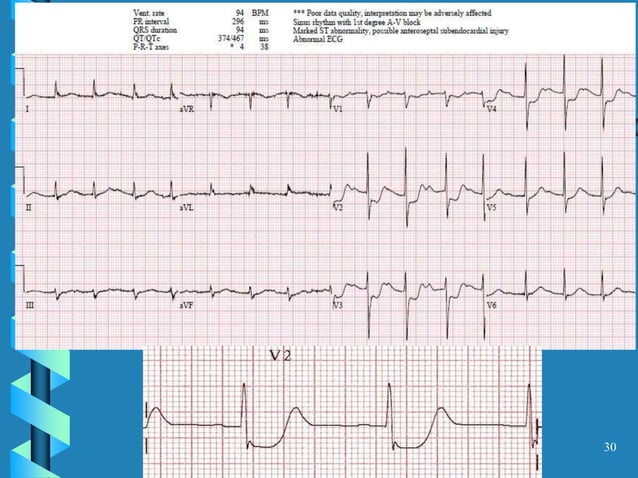 BASIC ECG INTERPRETATION PRESENTATION .ppt | Heart and Cardiovascular Diseases | Diseases and ...