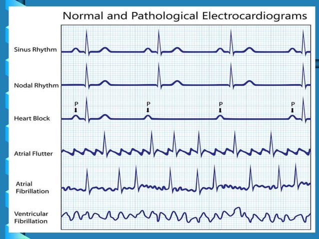 BASIC ECG INTERPRETATION PRESENTATION .ppt | Heart and Cardiovascular Diseases | Diseases and ...