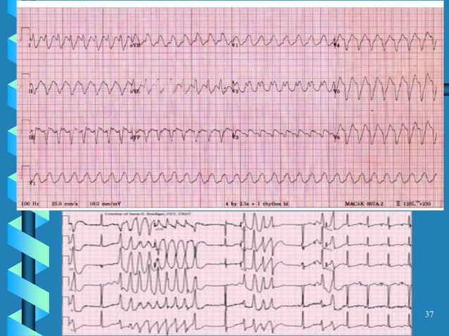 BASIC ECG INTERPRETATION PRESENTATION .ppt | Heart and Cardiovascular ...