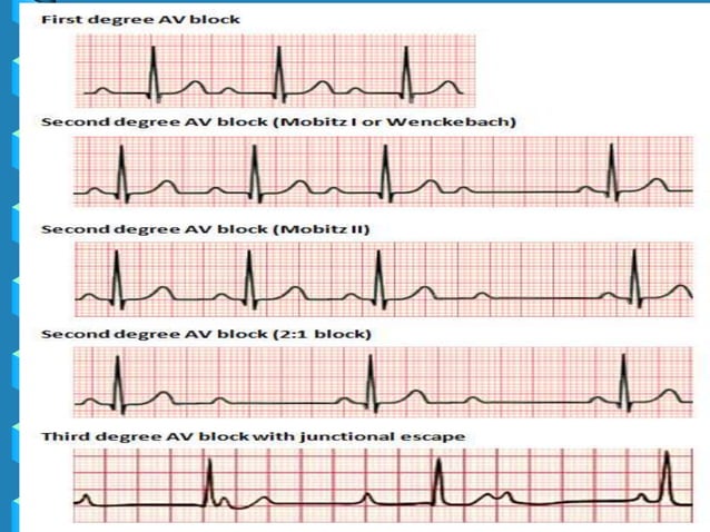 BASIC ECG INTERPRETATION PRESENTATION .ppt | Heart and Cardiovascular Diseases | Diseases and ...