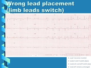 BASIC ECG INTERPRETATION PRESENTATION .ppt | Heart and Cardiovascular ...