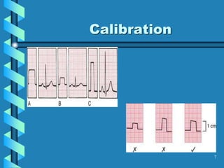 BASIC ECG INTERPRETATION PRESENTATION .ppt | Heart and Cardiovascular ...