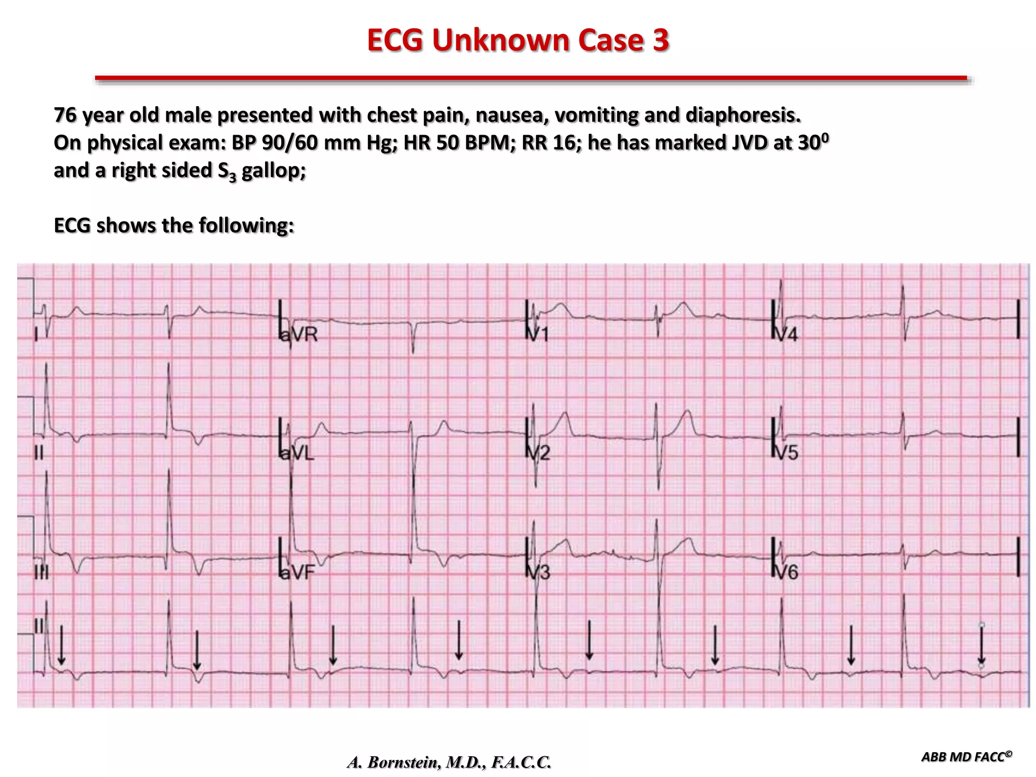 Basic ECG lecture 04 26 2018 | PPT
