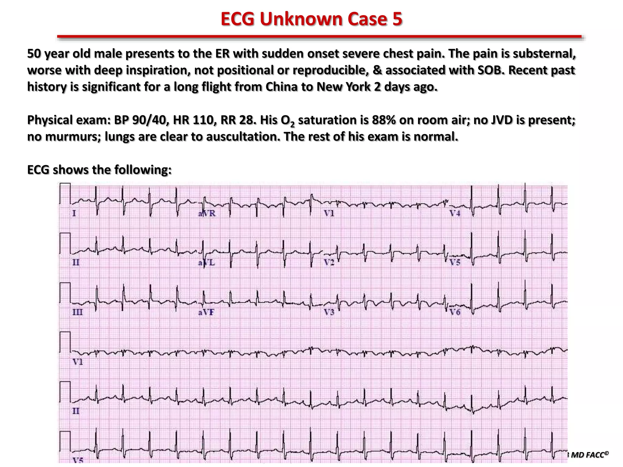 Basic ECG lecture 04 26 2018 | PPT