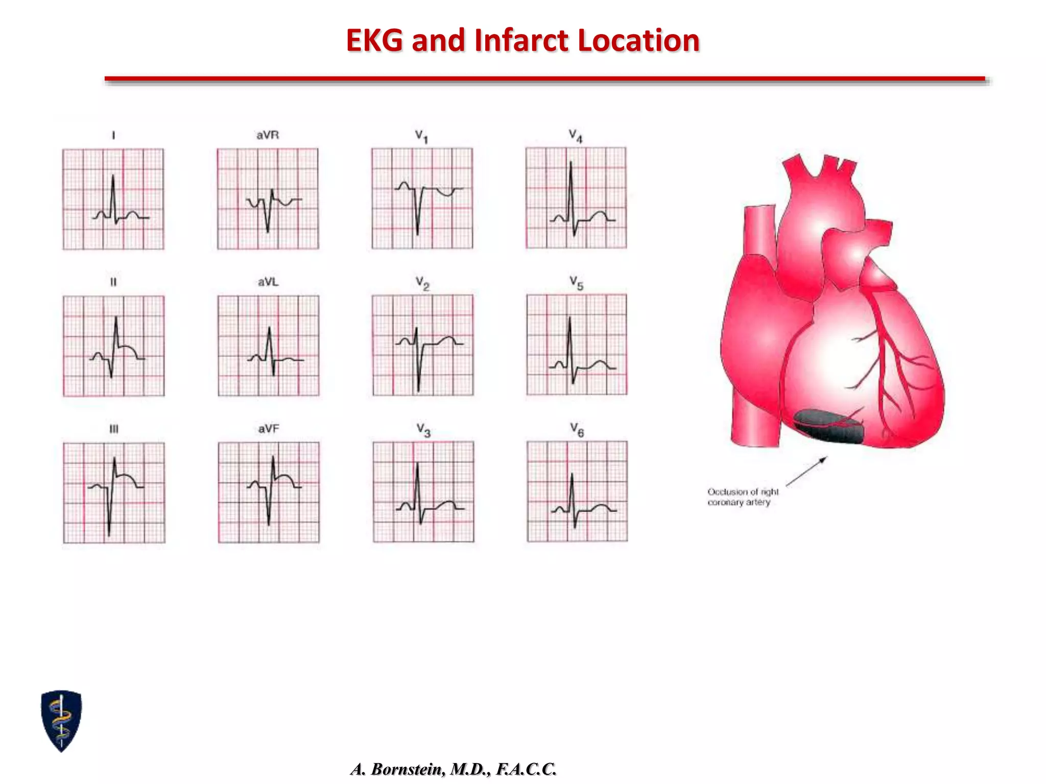 Basic ECG lecture 04 26 2018 | PPT