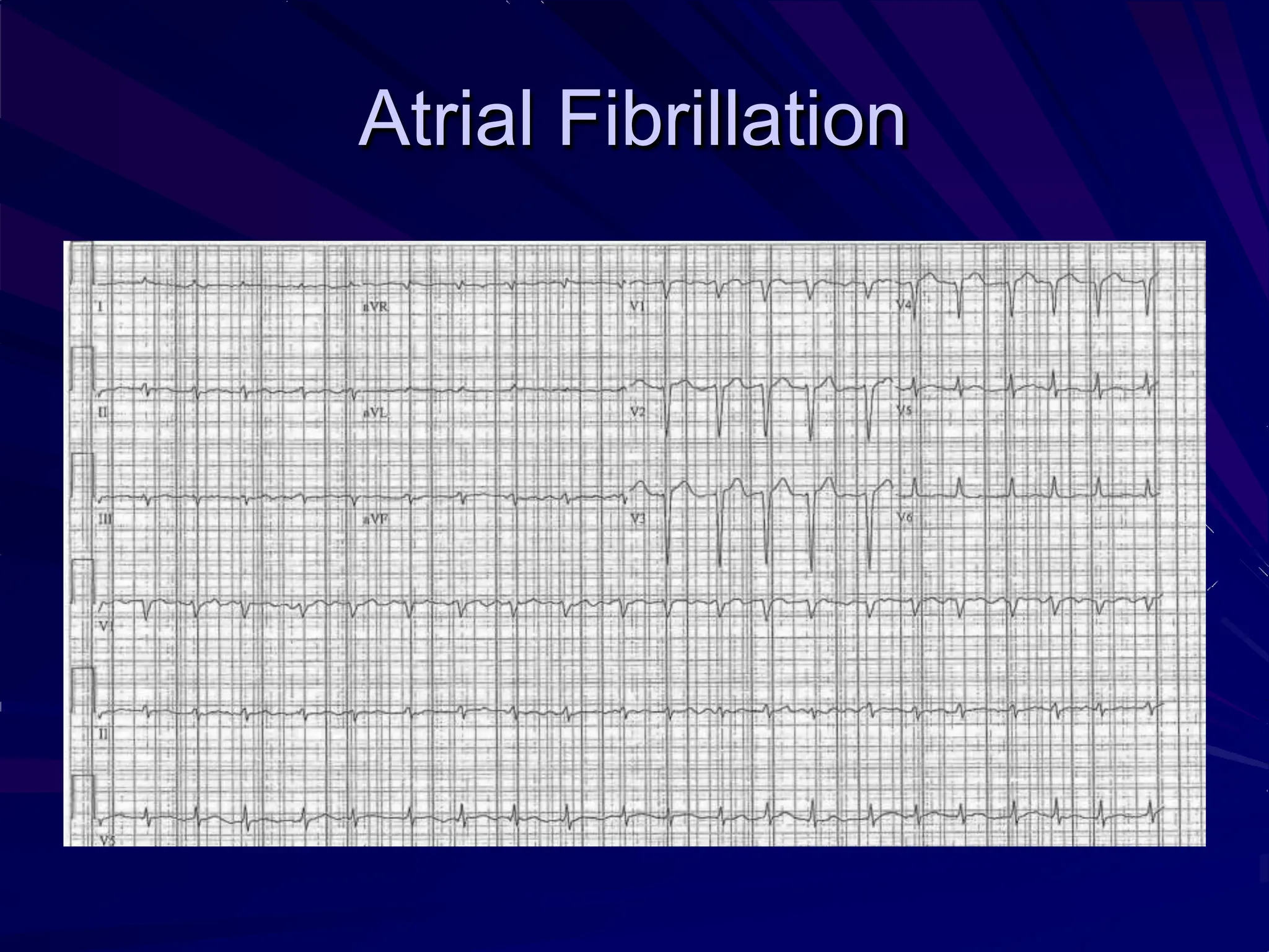 BASIC ECG RTHYM RAJI.pptx ACLS PREPARATION | PPT