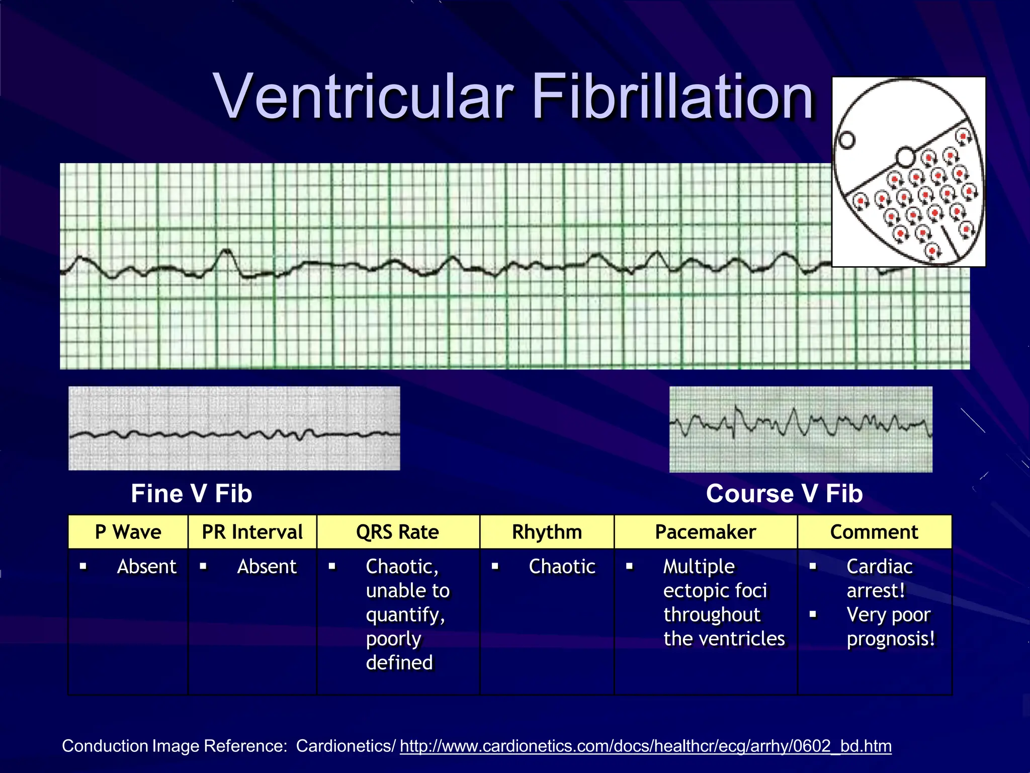 BASIC ECG RTHYM RAJI.pptx ACLS PREPARATION | PPT