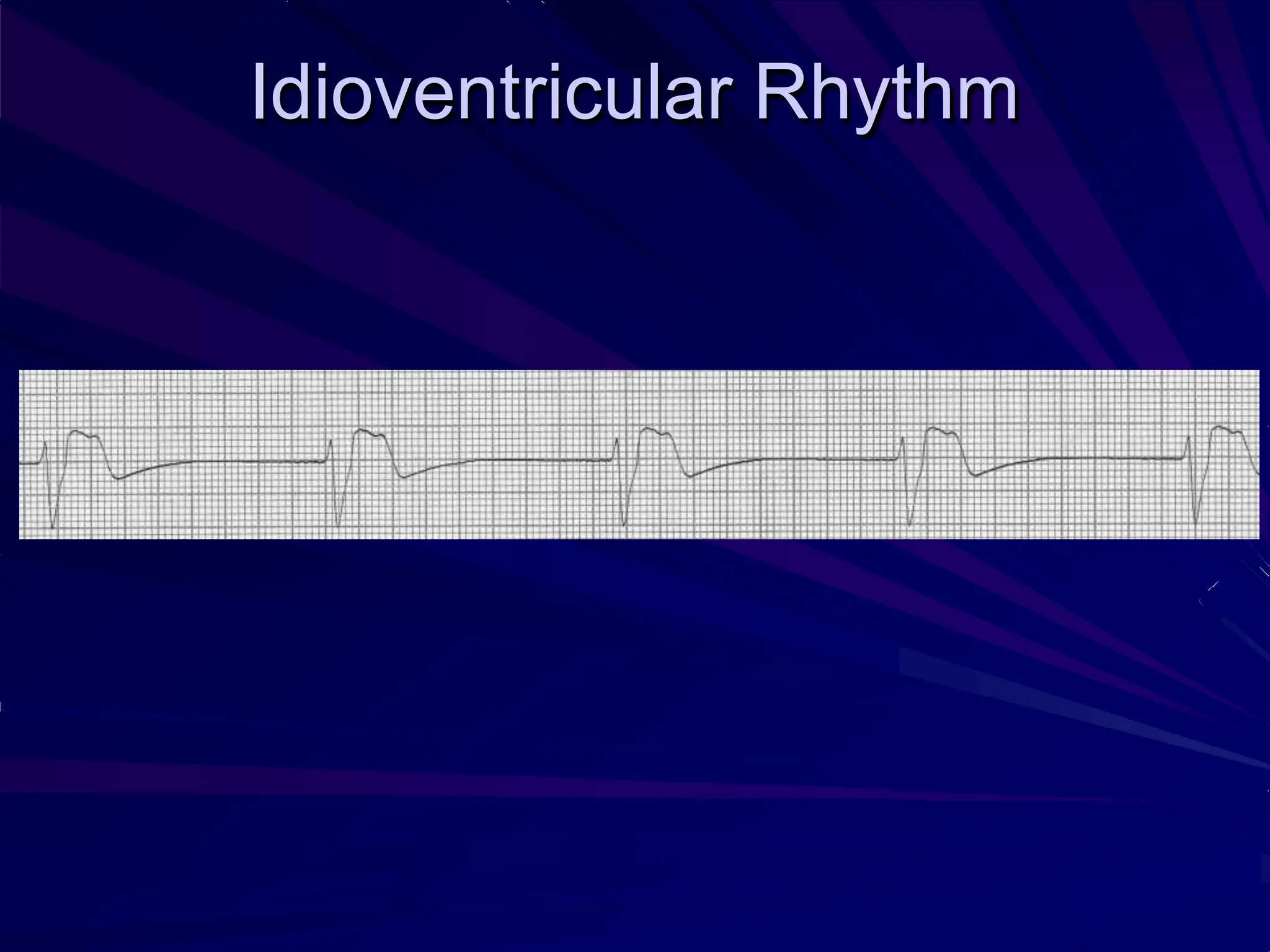 BASIC ECG RTHYM RAJI.pptx ACLS PREPARATION | PPT