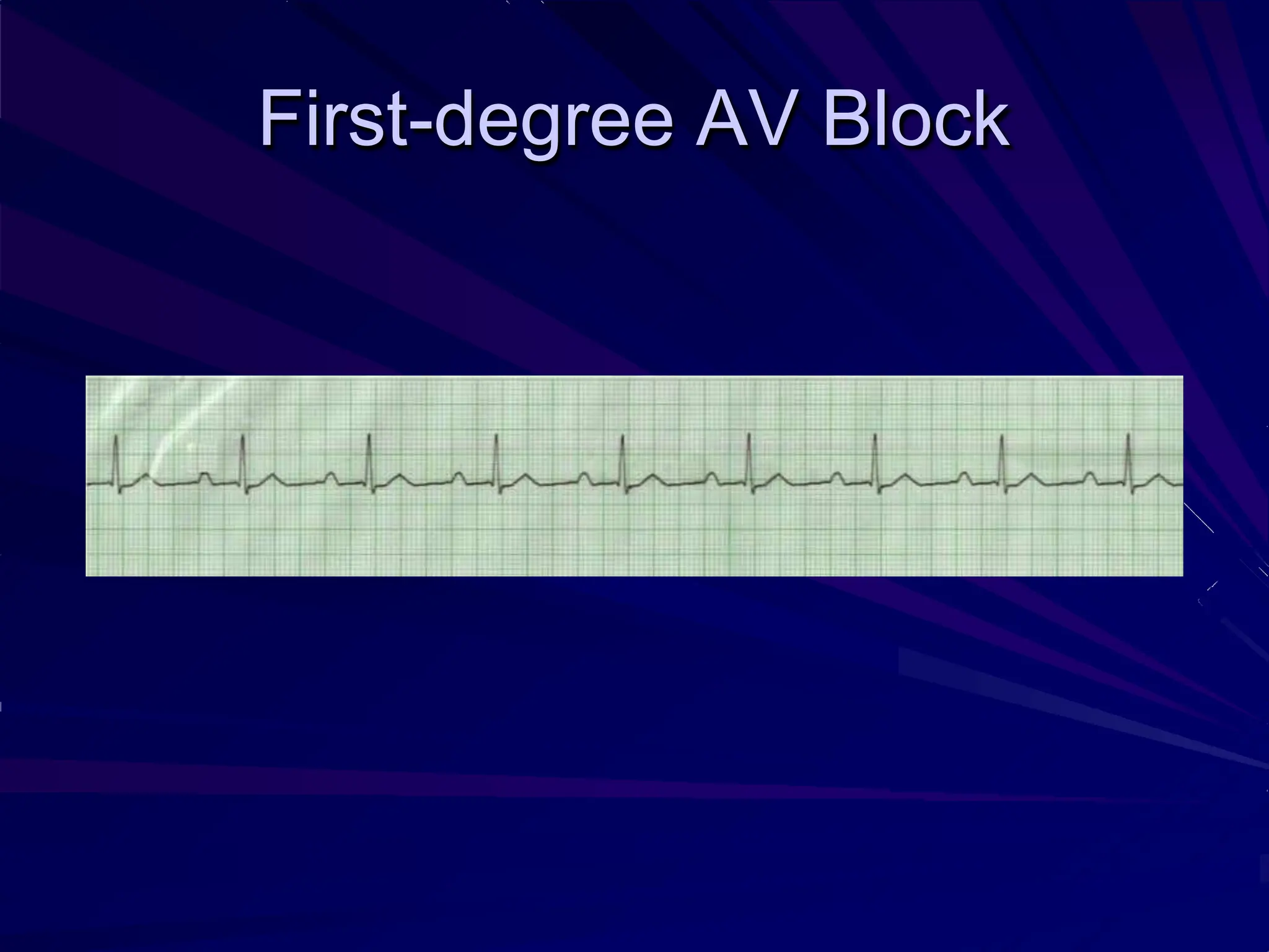 BASIC ECG RTHYM RAJI.pptx ACLS PREPARATION | PPT