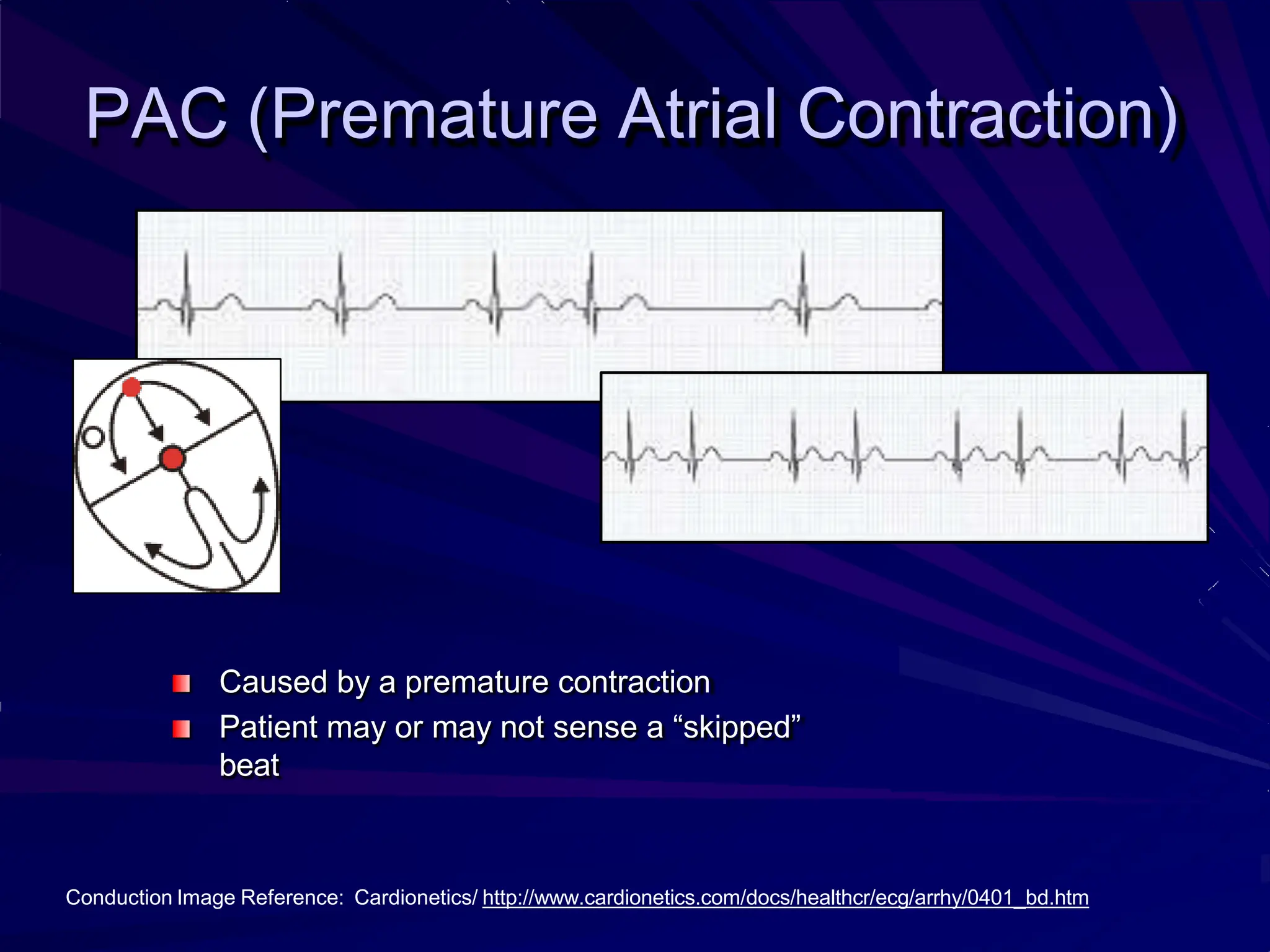 BASIC ECG RTHYM RAJI.pptx ACLS PREPARATION | PPT