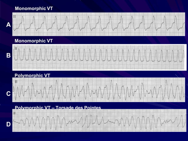 BASIC ECG RTHYM RAJI.pptx ACLS PREPARATION | PPT